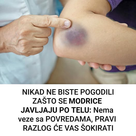 Modrice po telu bez razloga I nogama I rukama I kod dece